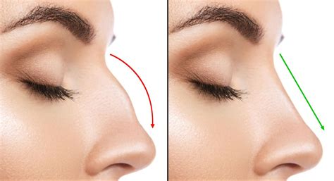 Rhinoplasty What To Expect Before And After A Nose Job Medfin