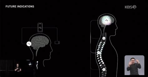 머스크 생각으로 컴퓨터 제어”인간 뇌에 인공칩 이식
