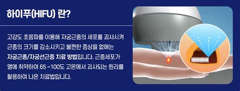 전립선암 수술 없이 초음파 치료도 가능하다