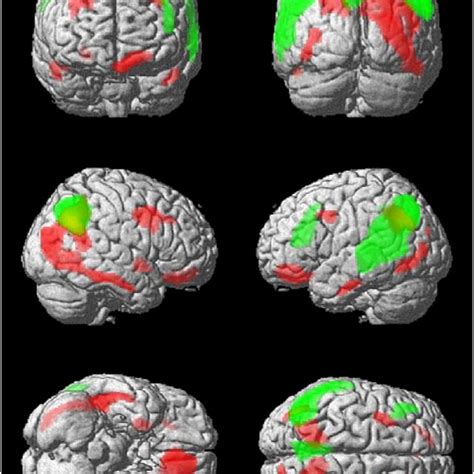 Comparison Of PIB PET Images Red And FDDNP PET Images Green In