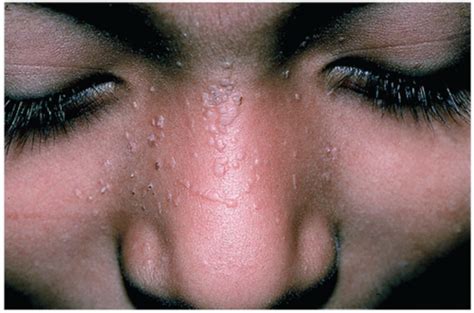 Warts Plastic Surgery Key