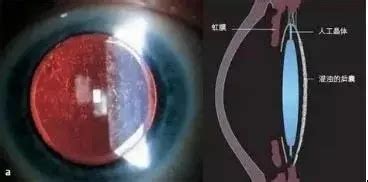 白内障术后看不清怎么办 医院新闻 新闻中心 公众版 仙居县人民医院