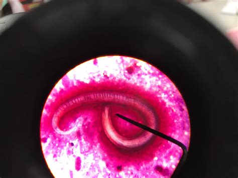 Toxocariasis Concise Medical Knowledge
