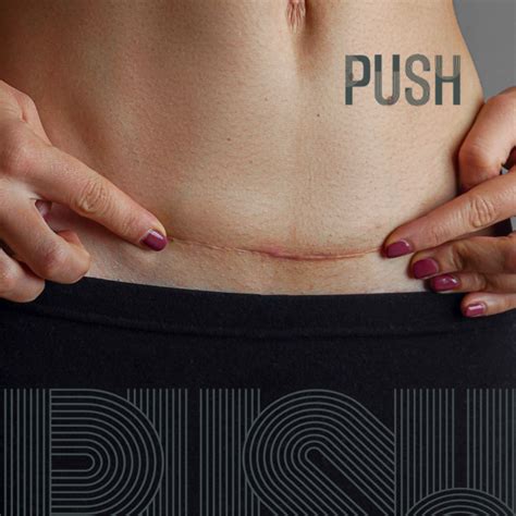 C Section Scar Release Therapy With Chiropractors Push Markham
