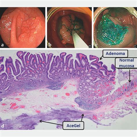 Endoscopic Image Of A Patient With Colon Neoplasm A White Light Image