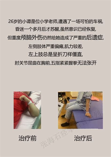 痉挛状态及治疗 痉挛 状态 治疗 神经外科 副教授 张海石 医师 医学 健康界