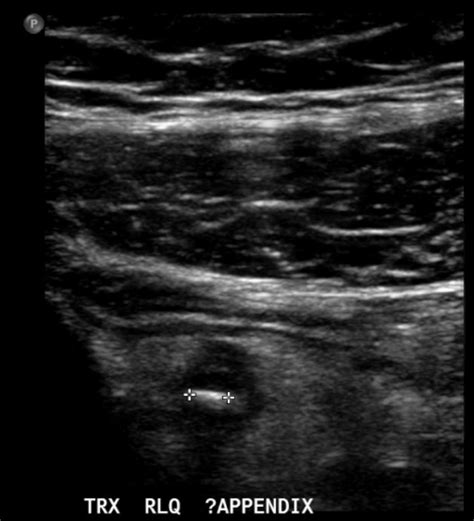 Appendicolith Ultrasound