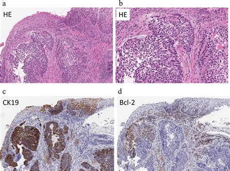 Microscopic Findings Of The Esophageal Tumor Biopsy A There Is