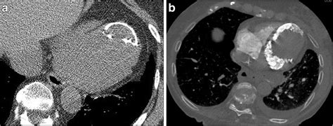 Myocardial Calcifications Pacs
