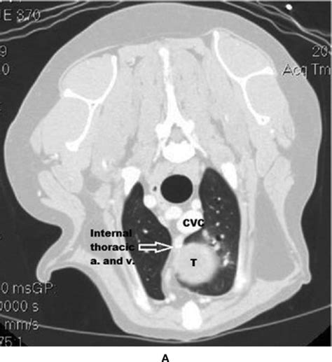 Thoracoscopic Mediastinal Mass Resection Veterian Key