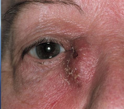 File Dacryocystitis  Eyewiki