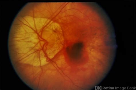Myopic Degeneration Cnvm Retina Image Bank
