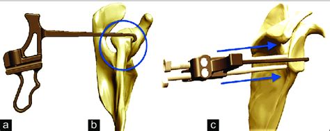 A The Guide Is Rotated To Capture The Anterior Edge Of The Glenoid