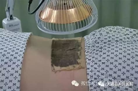 大通县人民医院中医科开展特色项目中药塌渍业务三伏贴也在持续进行中有需求的患者快来我院中医科咨询就诊吧