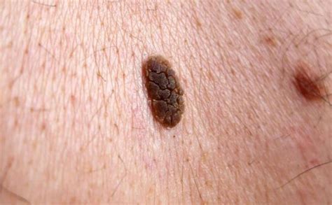 Keratoza Seboreică Cauze Simptome Diagnostic și Tratament Derma Estetica