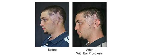 Auricular Ear Prosthesis For Osseointegrated Ear Implant Custom Prosthetic Designs Inc