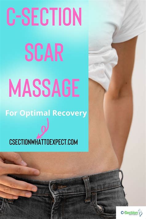 C Section Scar Recovery Artofit