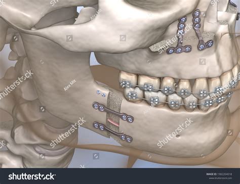 Maxillomandibular Advancement Surgery Medically Accurate Dental Stock