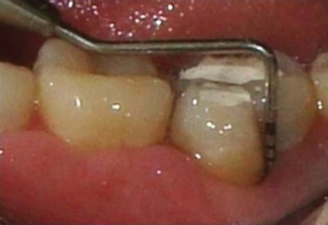 Paramolar Concrescence And Periodontitis Pmc
