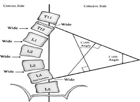 Sagittal View Of Scoliosis Affected Spinal Canal Registration And Atlas