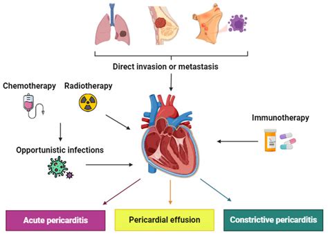 Pericarditis Causes