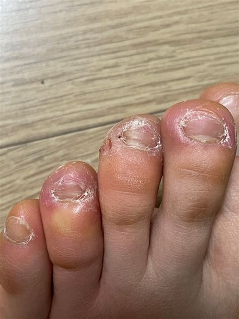 발가락 피부 벗겨짐 관리 지식in