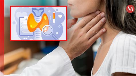 Qué Es La Tiroiditis De Hashimoto Y Cuáles Son Los Síntomas Grupo Milenio
