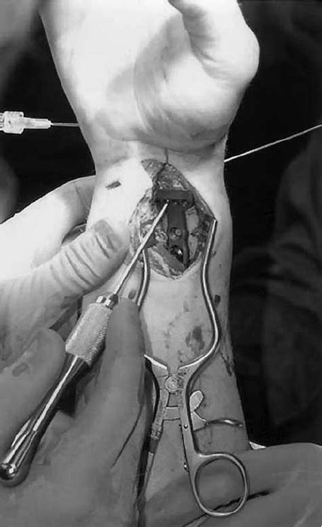Volar Platform Plating During Arthroscopy Download Scientific Diagram