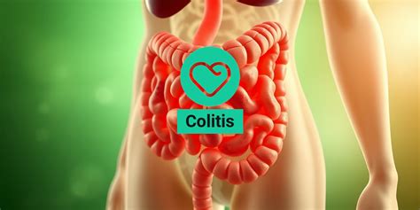 Colitis Understanding Symptoms Causes And Treatments • Yesil Health Ai