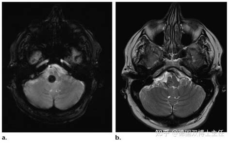 图文并茂：快速了解延髓解剖结构及常见综合征 知乎