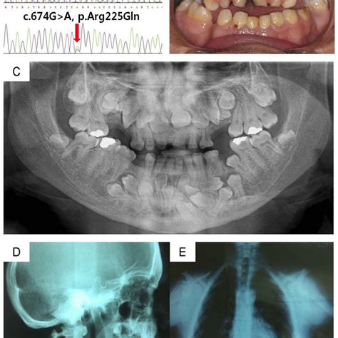 Pdf Runx2 Mutations In Cleidocranial Dysplasia