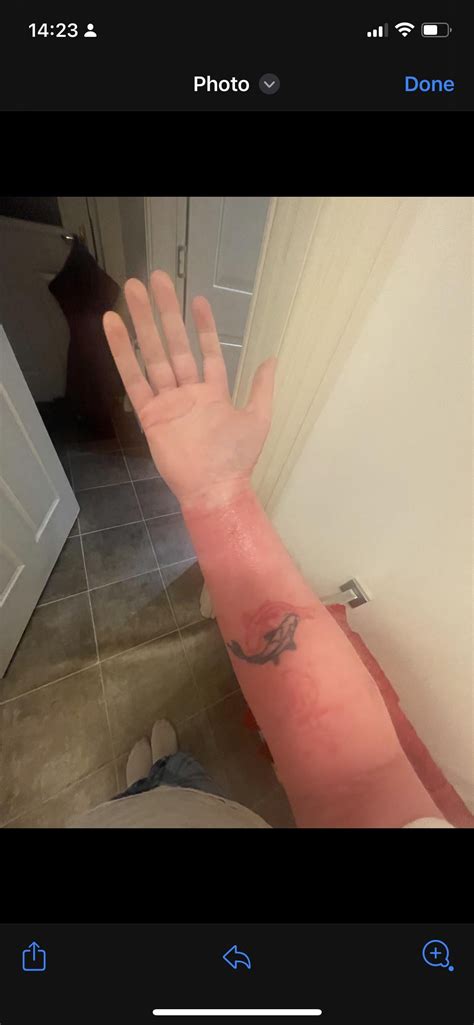 2 Week Improvement On Dupixent Rtswithdrawal