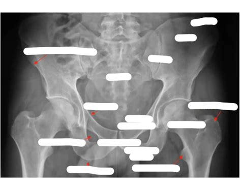 X Ray Of Pelvis Quiz