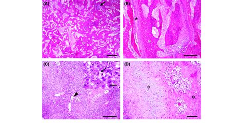 Hande Stained Sections Of A Multilobular Tumor Of Bone Removed During The Download Scientific