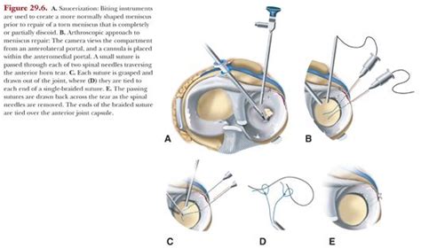 Discoid Lateral Meniscus Treatment Oargv