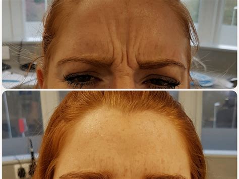 Facial Rejuvenation Anti Wrinkle Botox Leeds