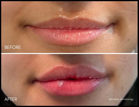Dermal Fillers Mclean And Potomac Dermatology