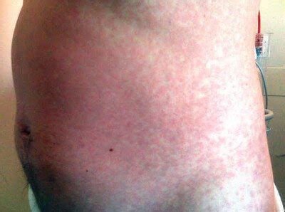 Maculopapular Rash Pictures Causes Diagnosis