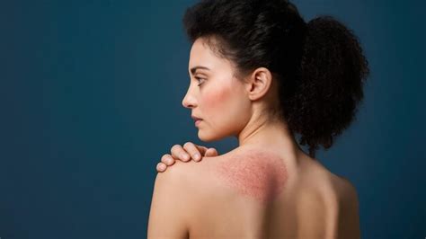 Allergic Dermatitis On The Skin Of A Womans Back Skin Disease Premium