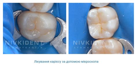 Лікування під мікроскопом