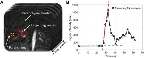 Improved Lung Perfusion After Left Pulmonary Artery Patch Enlargement