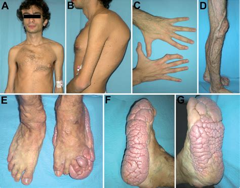Figure 1 From Proteus Syndrome Is A Rare And Complex Congenital