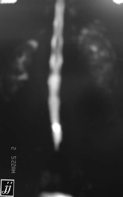 Antelisthesis Of L4 Radiopaedia