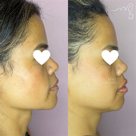 Harmonização Facial Dra Malu Macedo Agende sua avaliação