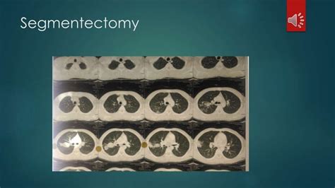 Pulmonary Resection Pptx Lung And Respiratory Health Diseases And