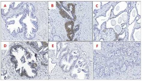 Maspin Expression Patterns In Different Prostatic Morphological Types