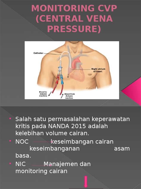 Pengukuran Central Venous Pressure Cvp 58 Off