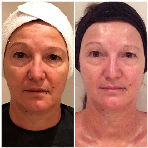 Thermalift Skin Tightening Facelift Before And After At Teresa Wolters Blog