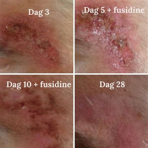 What Color Is Actinic Keratosis Cream