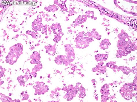 Micropapillary Adenocarcinoma